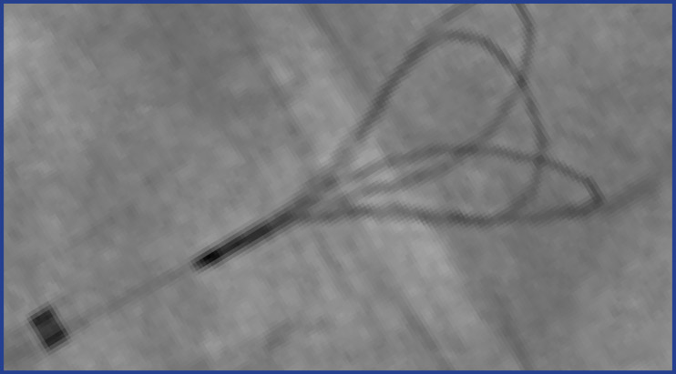 EN Snare®血管内陷阱系统- Merit医疗 - bob电博app