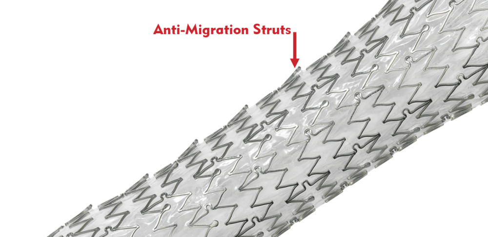 Abordaje de las complicaciones de la colocación de stent esofágicos con ...