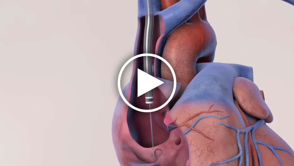 Used for fistula or grafts HeRO save ® graft - Merit Medical - bob电博app