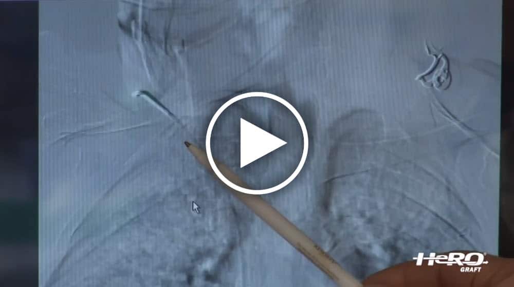 HeRO ® graft implants - Merit Medical - bob电博app